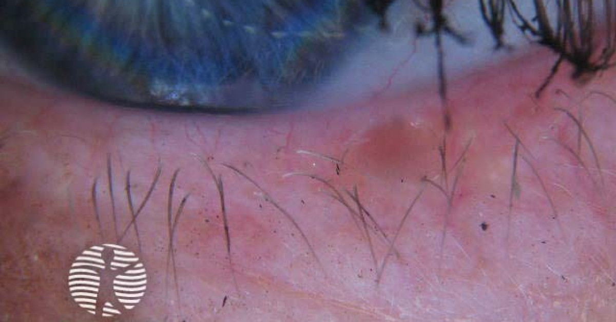 Hidrocystoma image