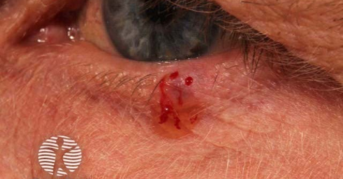 hidrocystoma image