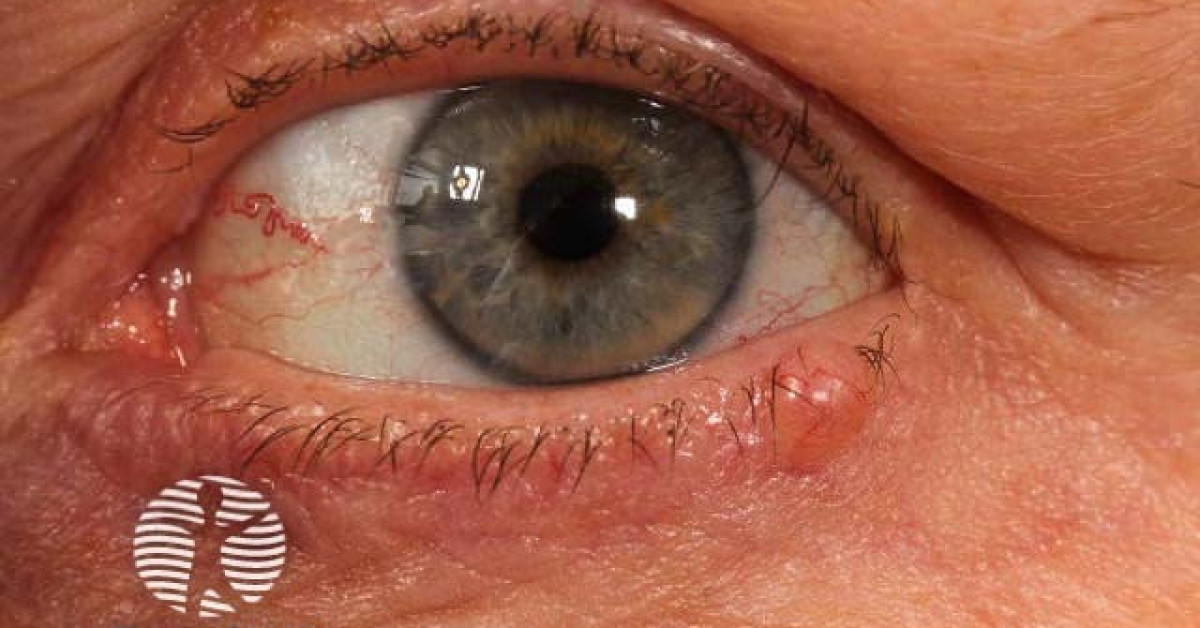 hidrocystoma image