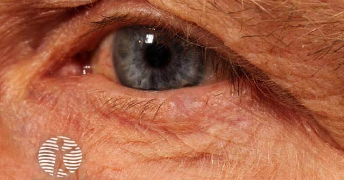 Hidrocystoma image