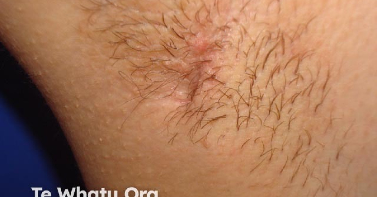Hidradenitis suppurativa of axilla image