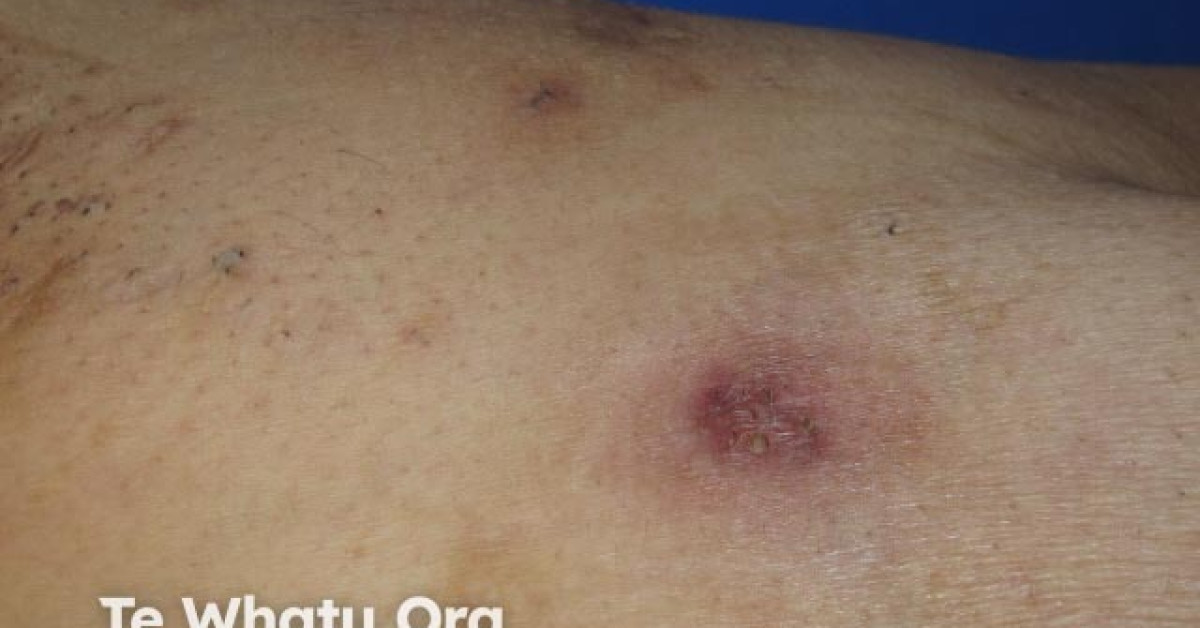 Hidradenitis suppurativa of axilla image