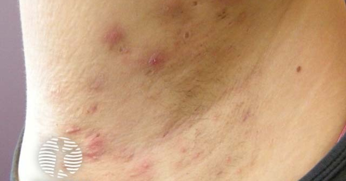 Hidradenitis suppurativa of axilla image