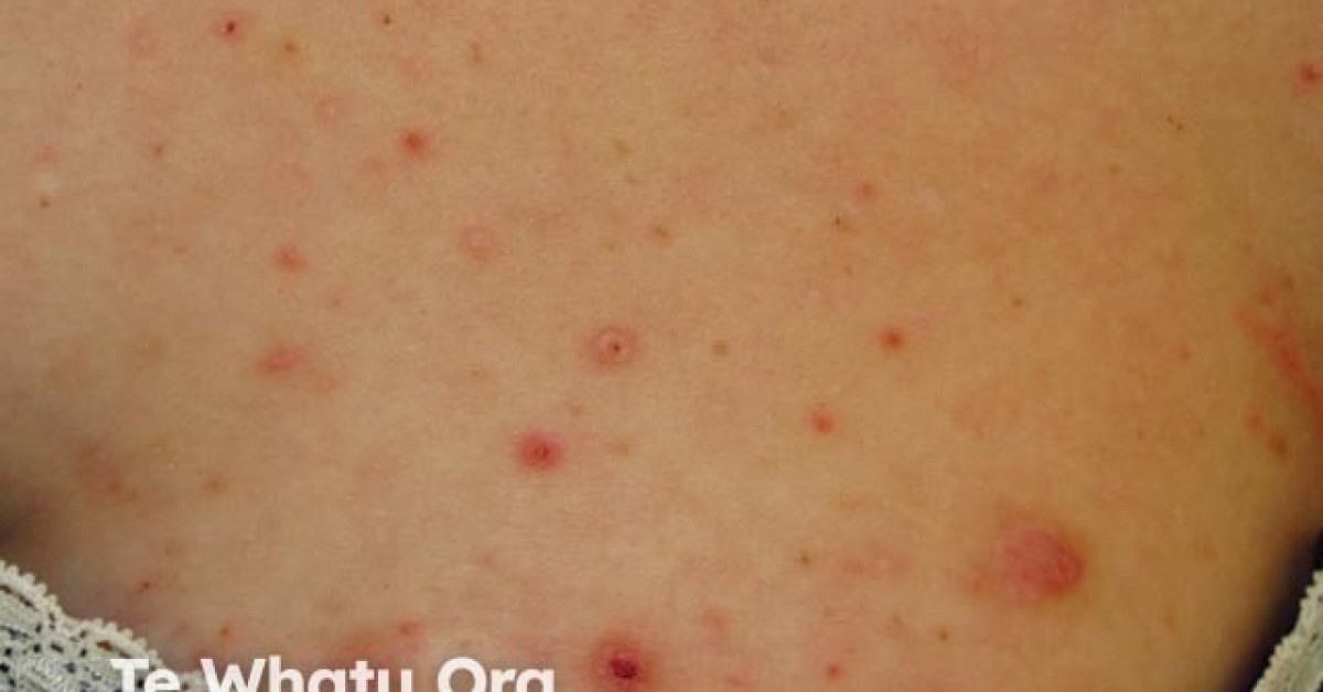 Hidradenitis suppurativa of breast image