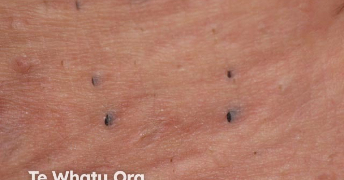 Comedones in hidradenitis suppurativa image