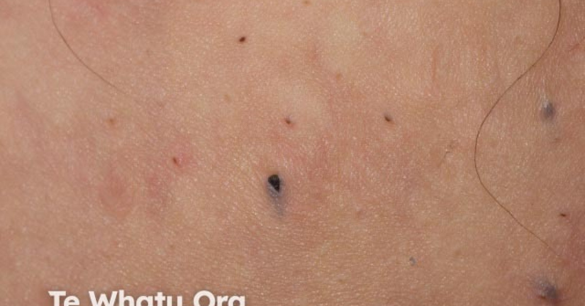 Comedones in hidradenitis suppurativa image