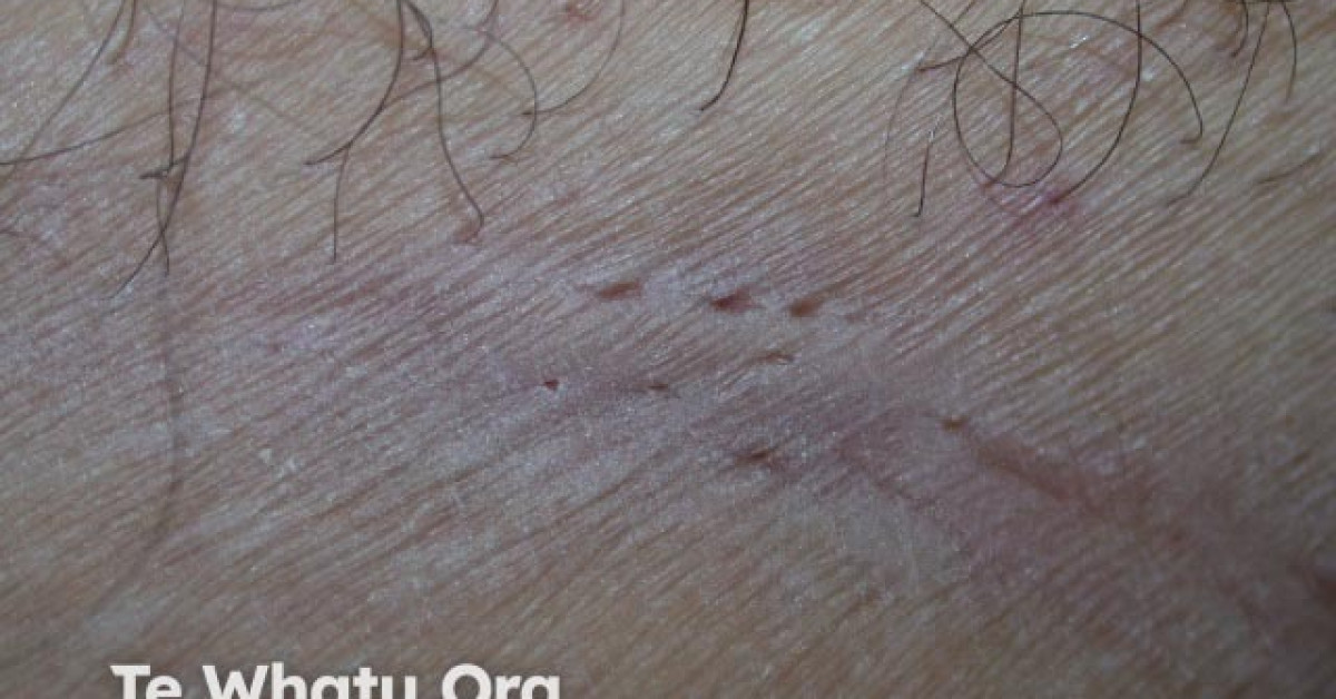 Comedones in hidradenitis suppurativa image