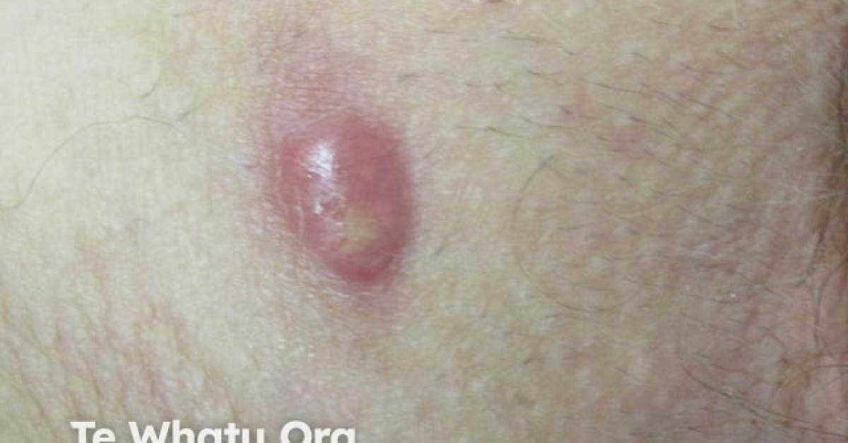 Inflammatory lesion in hidradenitis suppurativa image