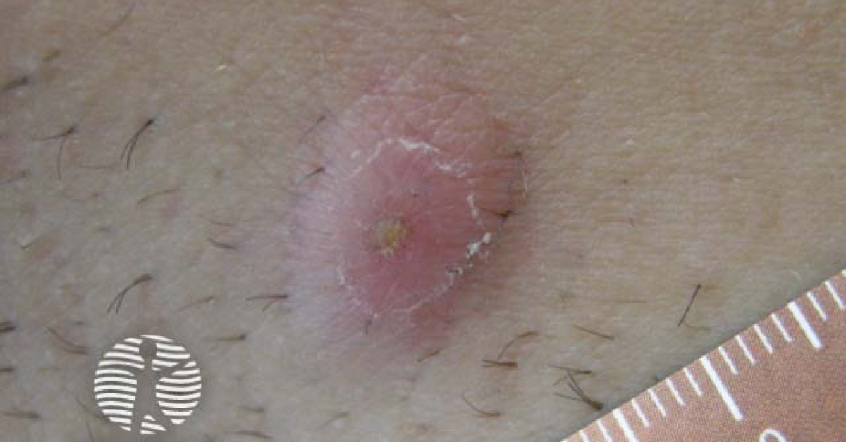 Inflammatory lesion in hidradenitis suppurativa image