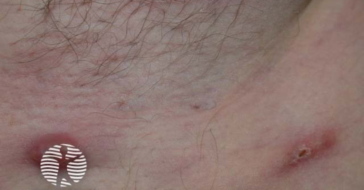 Inflammatory lesion in hidradenitis suppurativa image