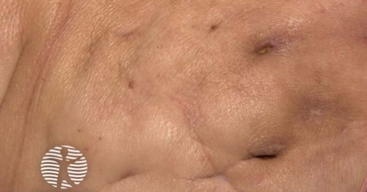 Scarring in hidradenitis suppurativa image