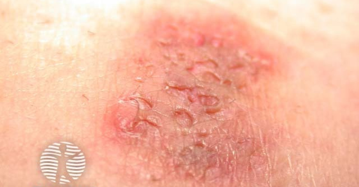 Scarring in hidradenitis suppurativa image