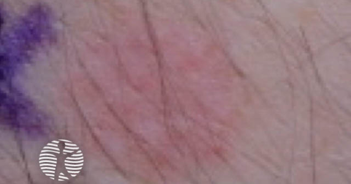 hydrocortisone butyrate patch sm image