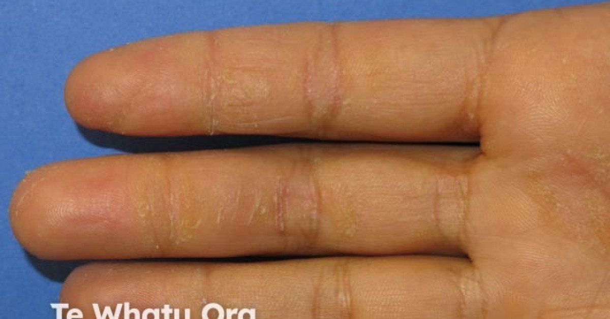Hyperkeratotic hand eczema image