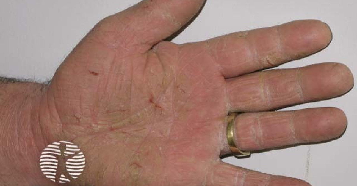 Hyperkeratotic hand eczema image