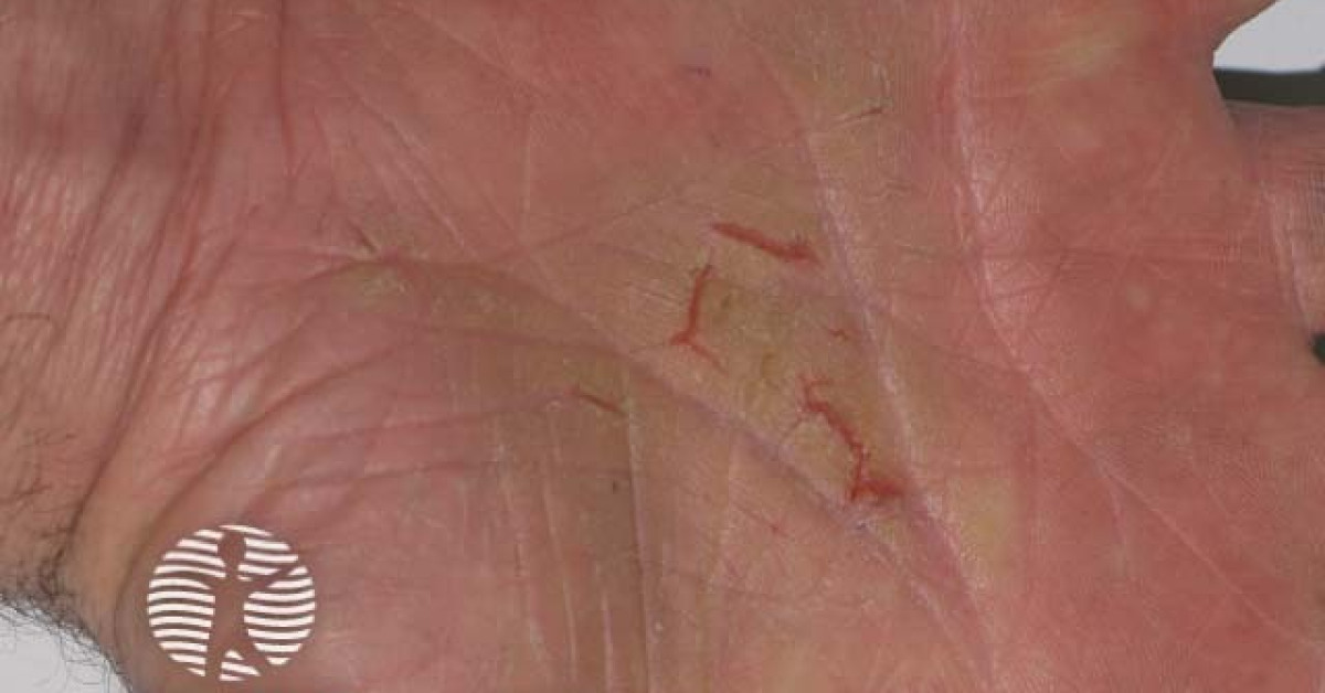 Hyperkeratotic hand eczema image