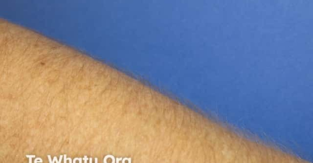 DermNet® - Hypertrichosis image