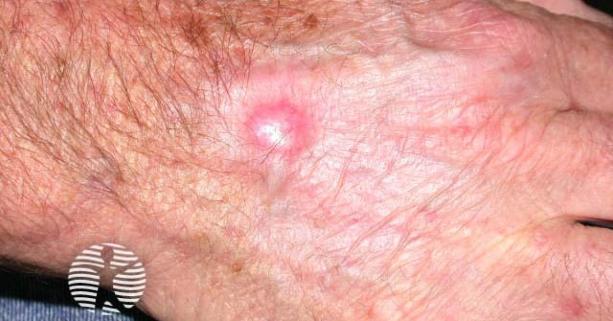 Recurrent basal cell carcinoma image