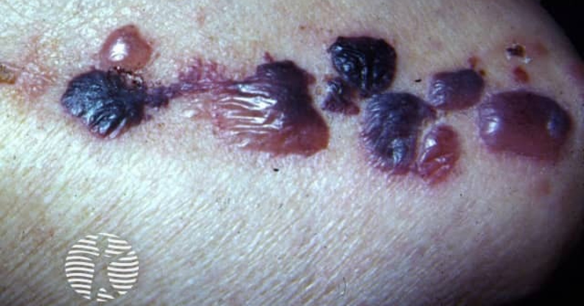 Bullous pemphigoid image