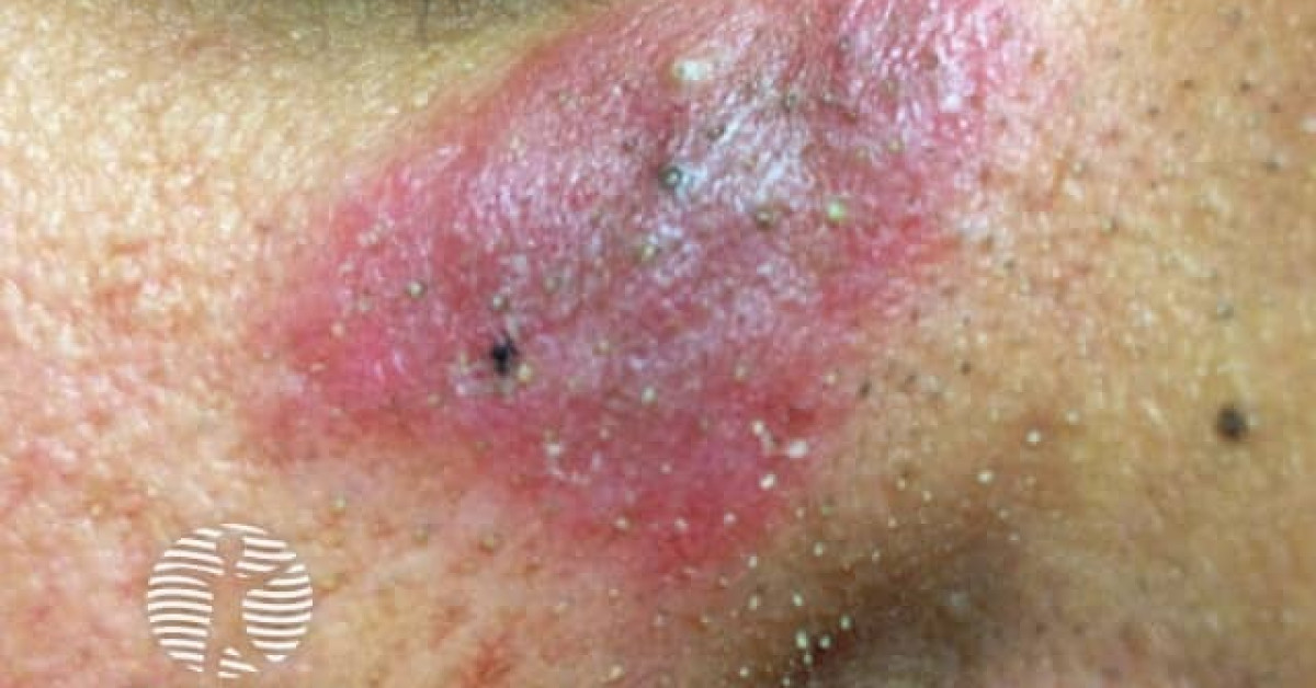 Chronic discoid lupus erythematosus image