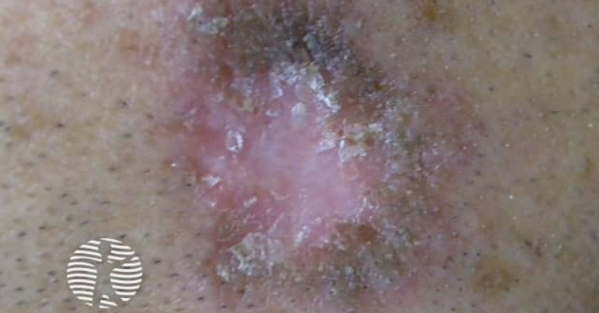 Chronic discoid lupus erythematosus image