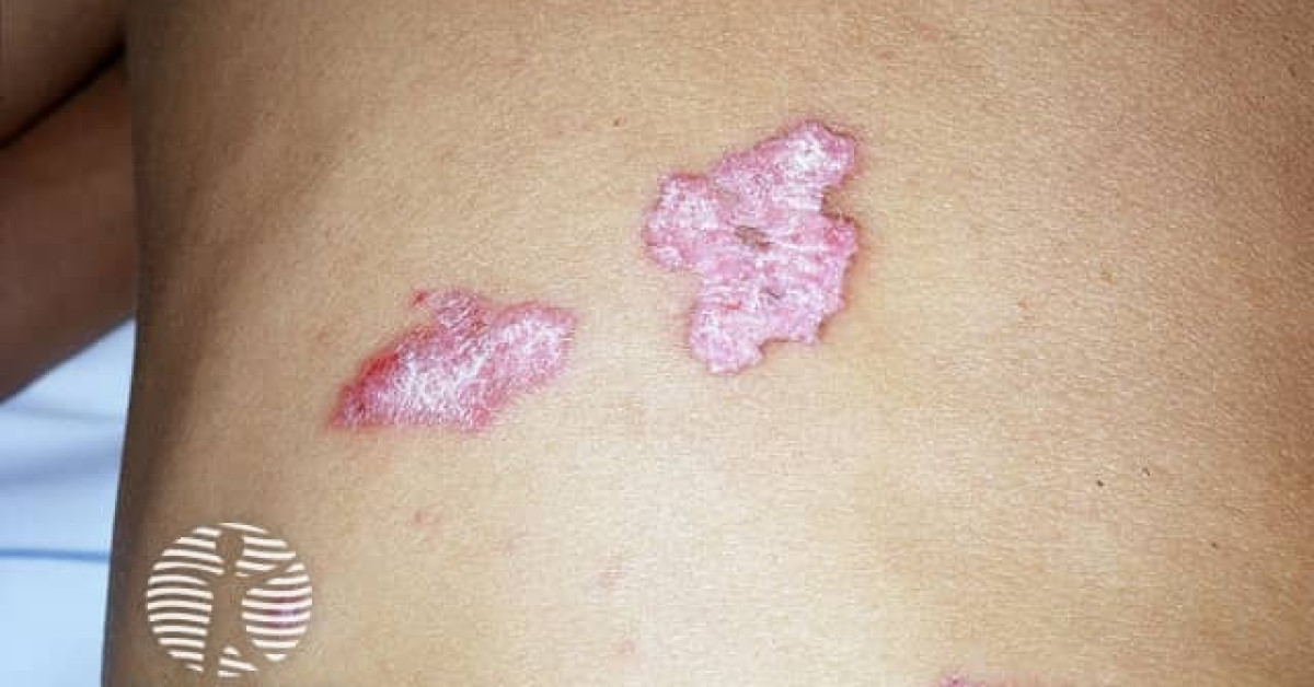 Chronic discoid lupus erythematosus image