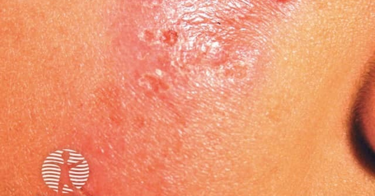 Chronic discoid lupus erythematosus image