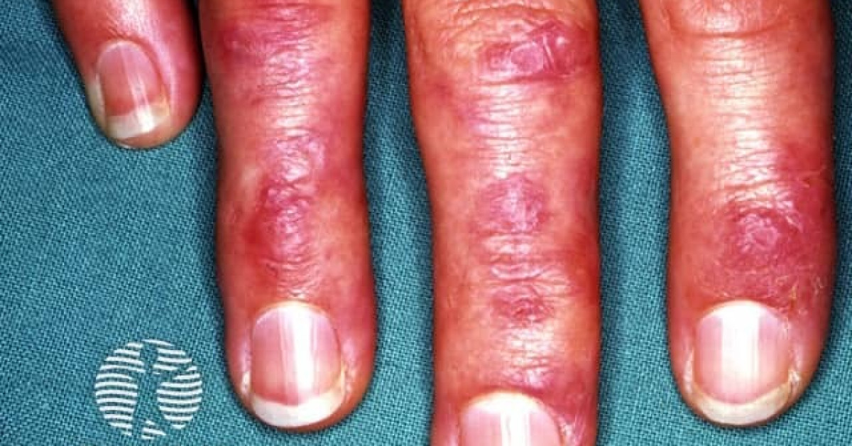 Dermatomyositis of the hand image