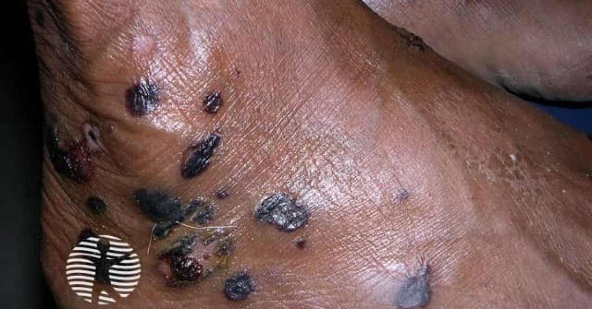 Epidermolysis bullosa acquisita image