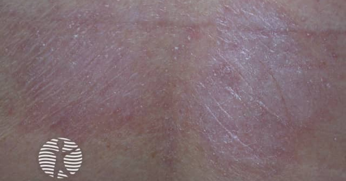 Extragenital lichen sclerosus image