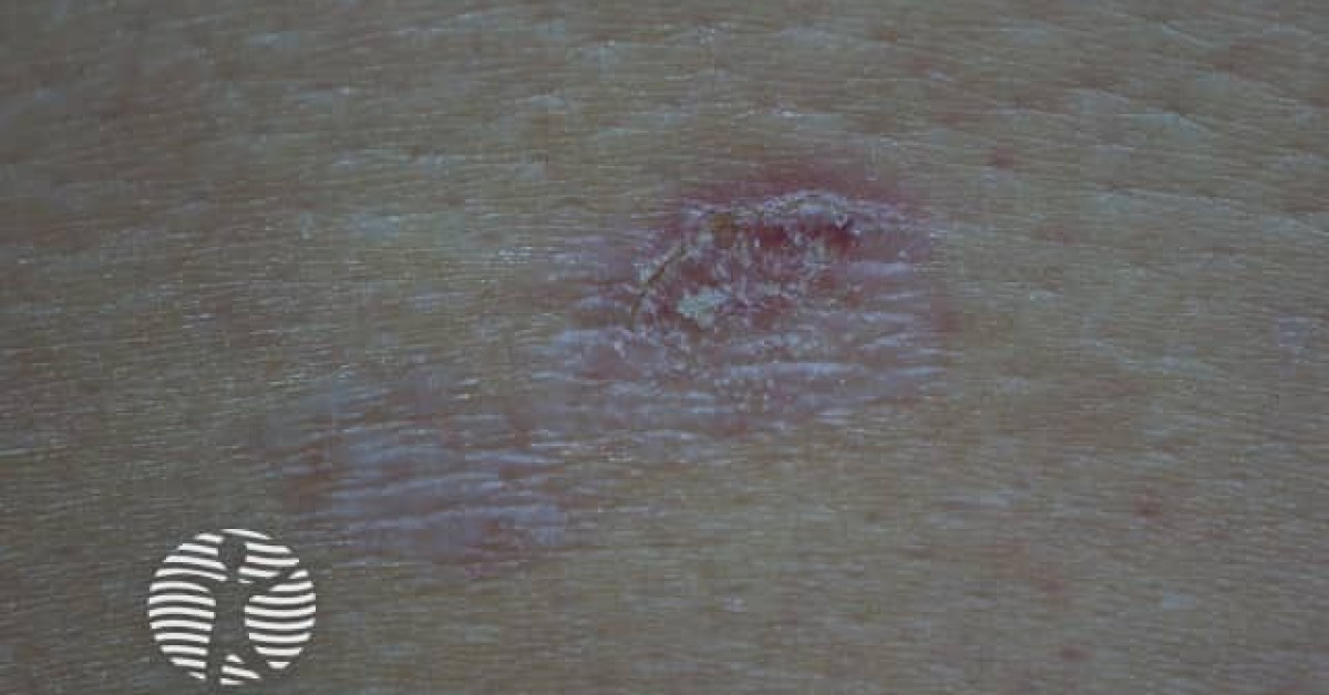 Extragenital lichen sclerosus image