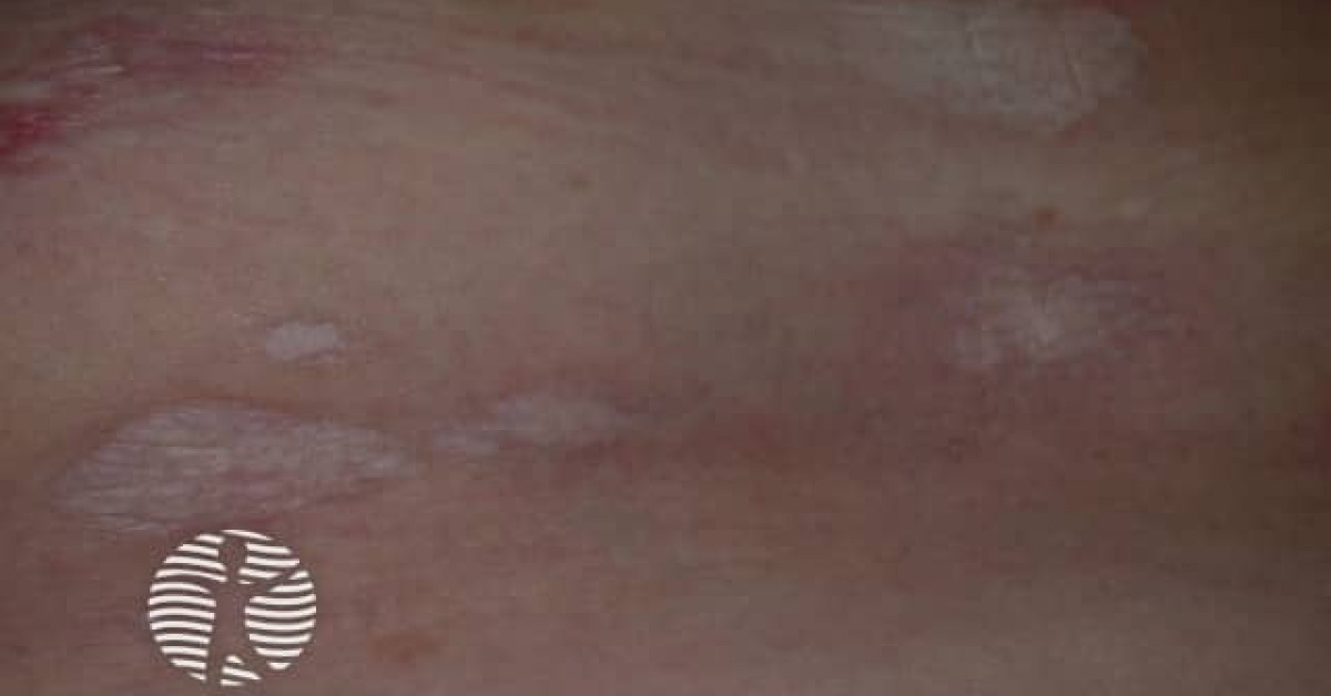 Extragenital lichen sclerosus image