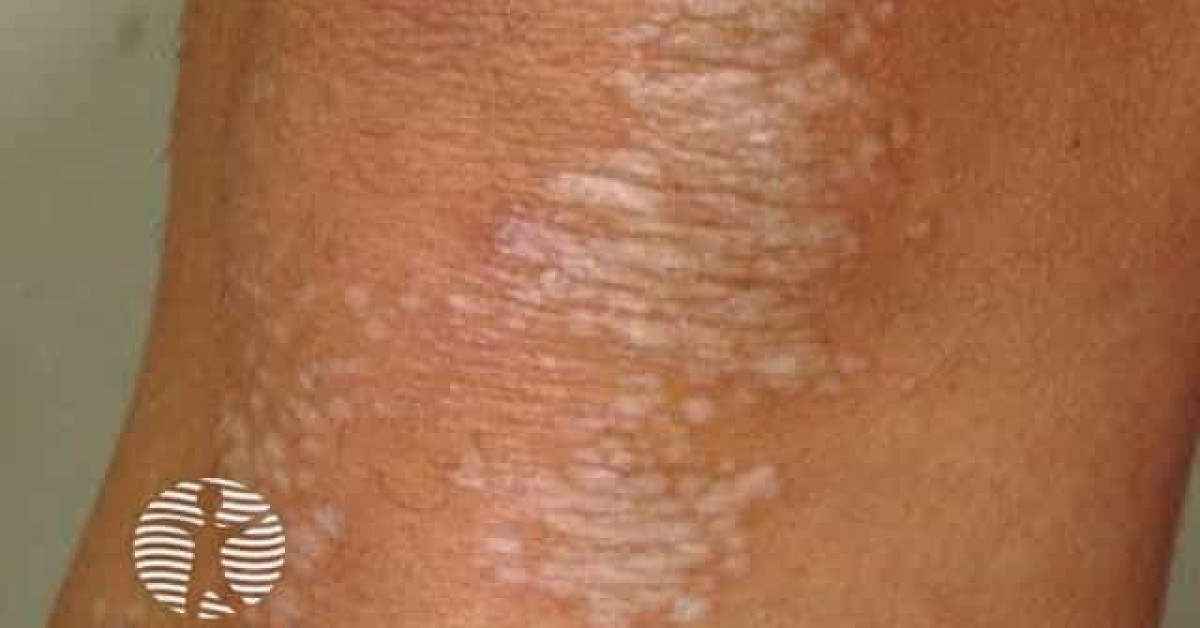 Extragenital lichen sclerosus image