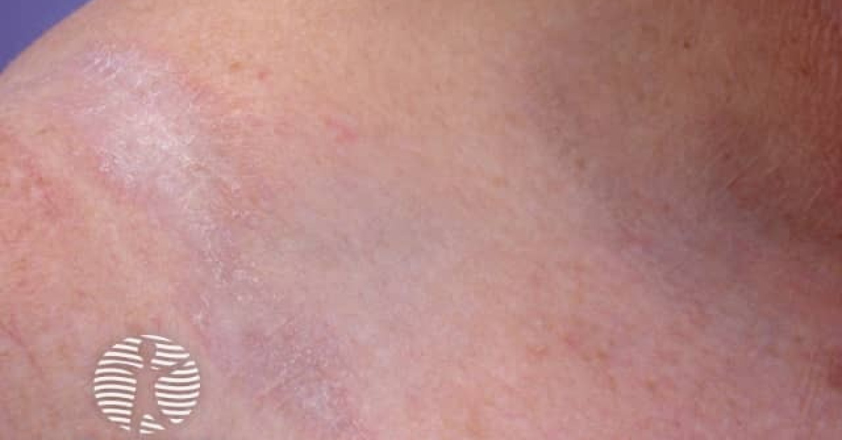 Lichen Sclerosus Image