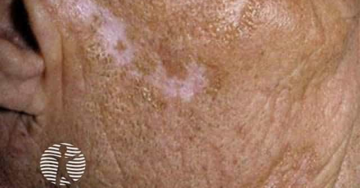 Cutaneous lupus erythematosus image