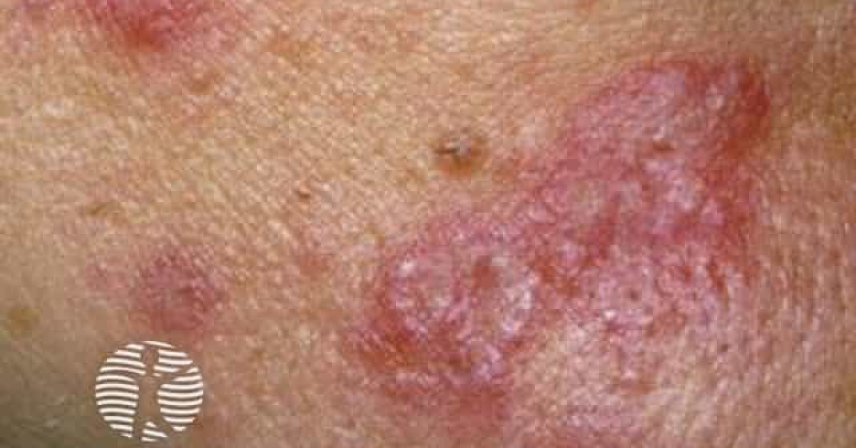 Cutaneous lupus erythematosus image