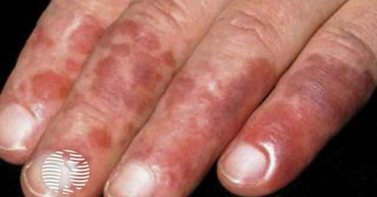 Cutaneous lupus erythematosus image