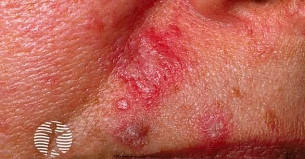 Cutaneous lupus erythematosus image