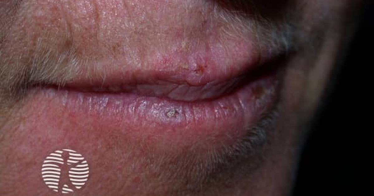 Cutaneous lupus erythematosus image