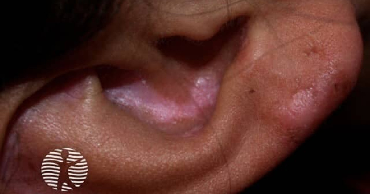 Cutaneous lupus erythematosus image