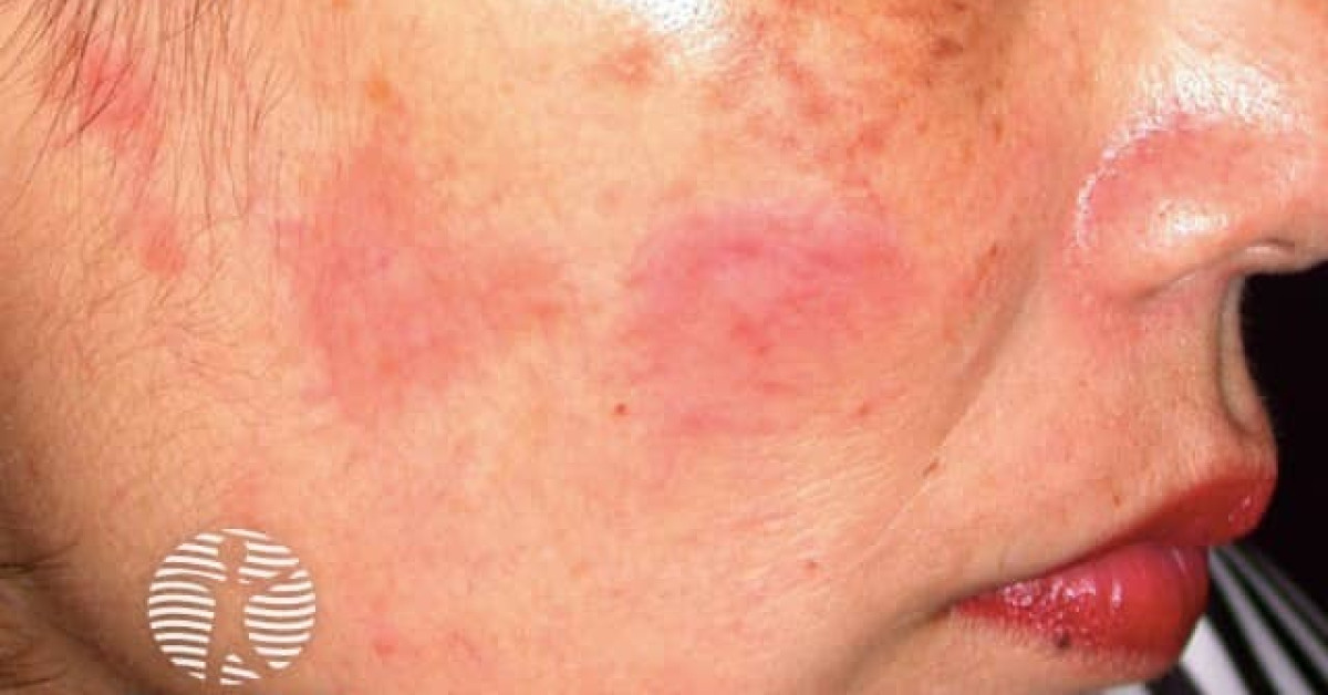 Cutaneous lupus erythematosus image