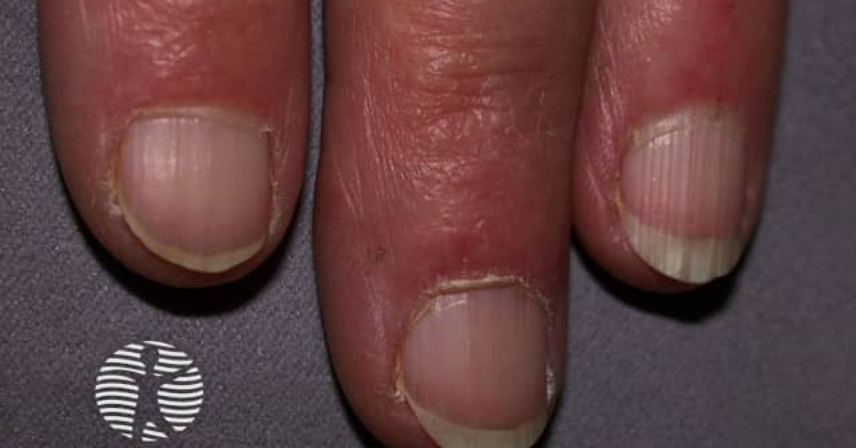 Cutaneous lupus erythematosus image