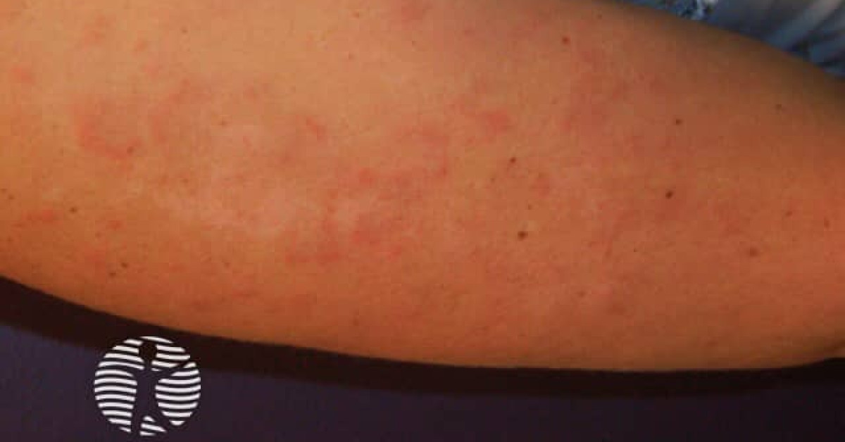 Cutaneous lupus erythematosus image