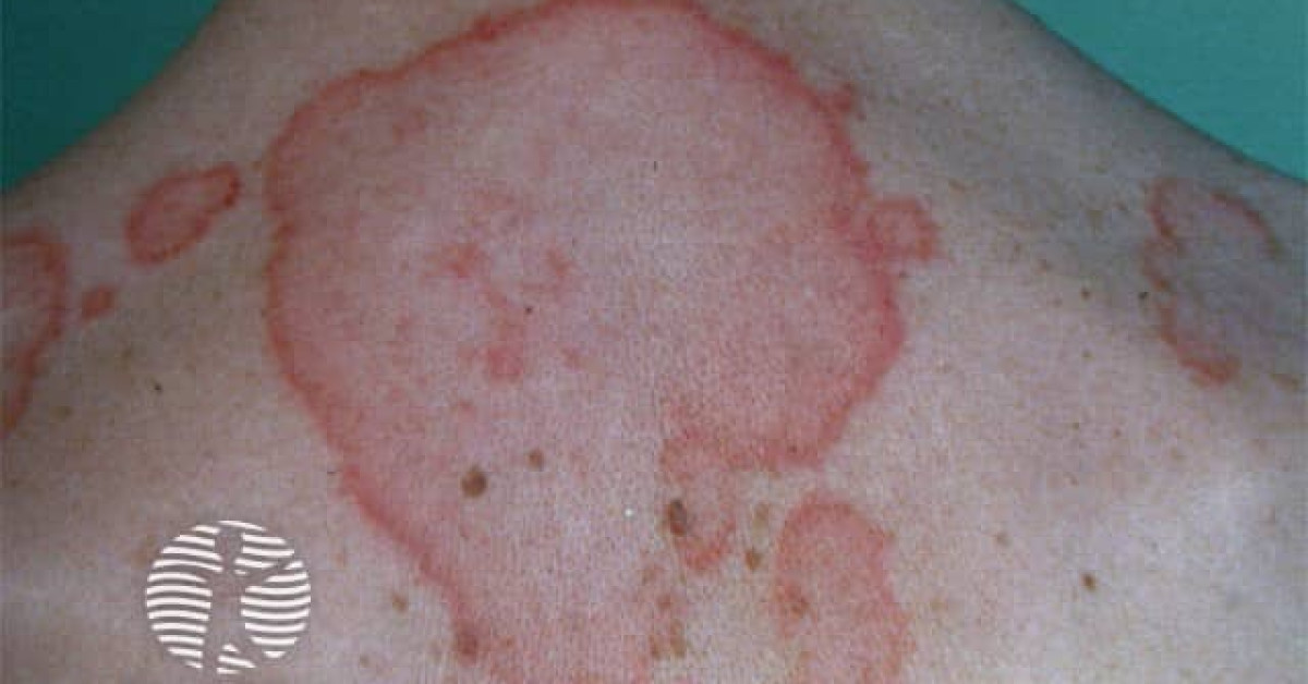 Cutaneous lupus erythematosus image