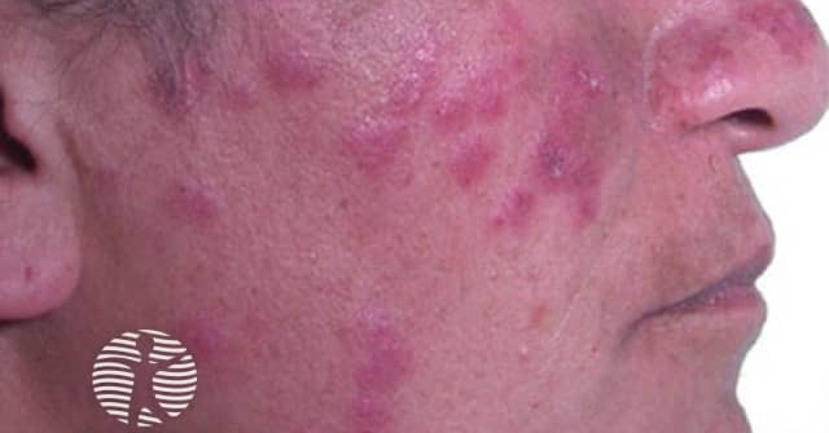 Cutaneous lupus erythematosus image