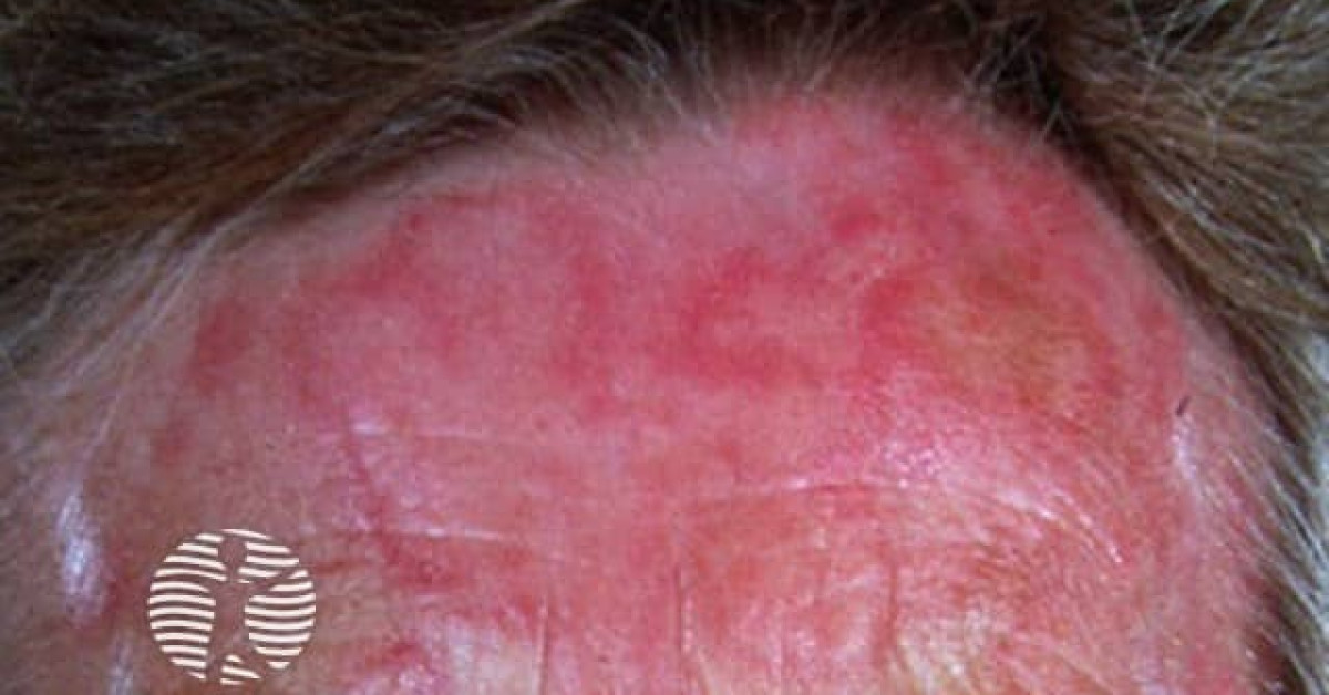 Cutaneous lupus erythematosus image