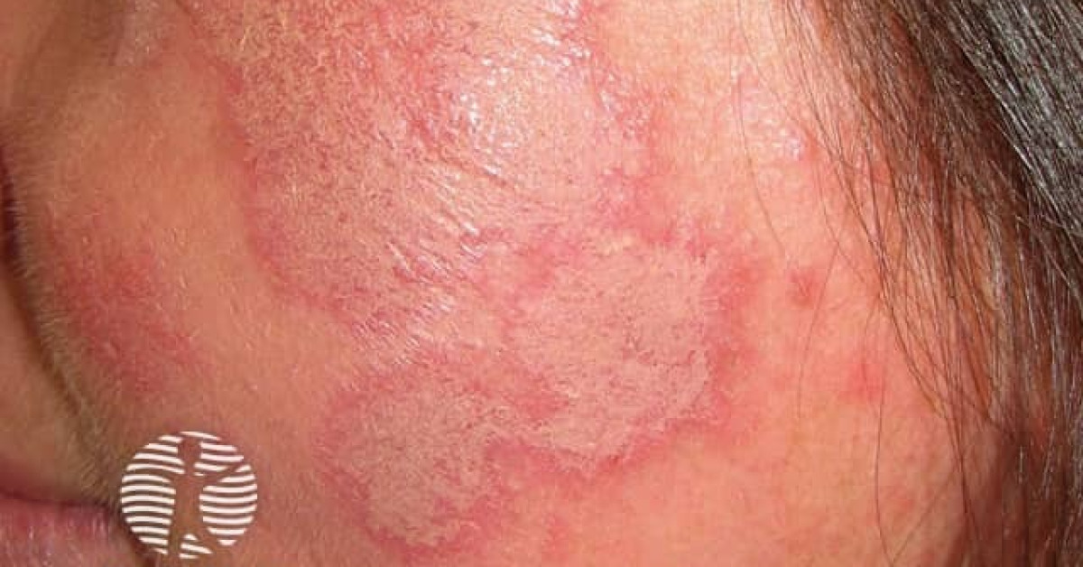 Cutaneous lupus erythematosus image