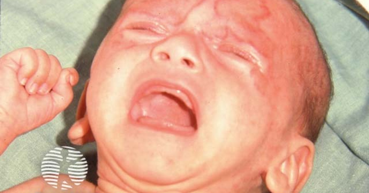 Neonatal lupus image