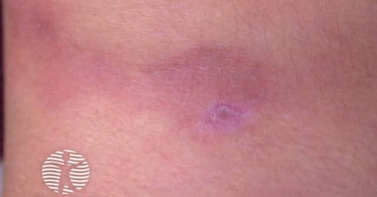 Lupus panniculitis image