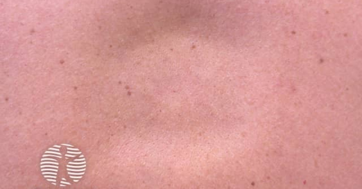 Lupus panniculitis image